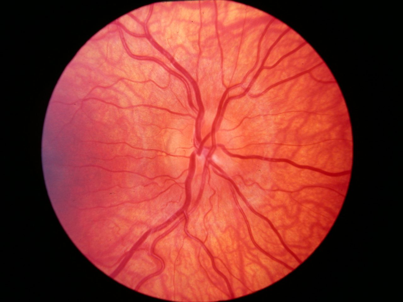 Retina & Macular Care - Virginia Eye Institute